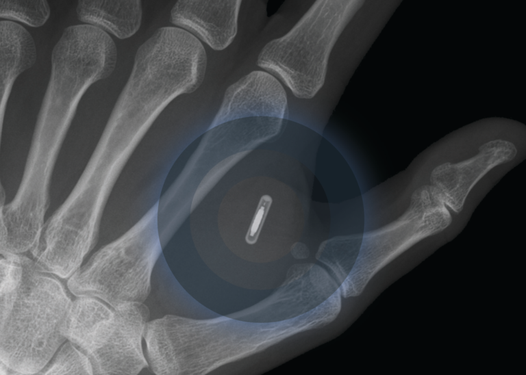 Implanted Microchip in Hand May Be Used to Verify COVID-19 Vax Status ...